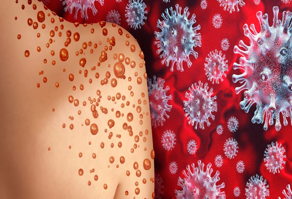 Оспа обезьян - будет хуже ковида? Что известно на сегодня